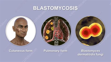 Clinical Presentations Of Blastomycosis 3d Illustration Stock Image F042 4946 Science