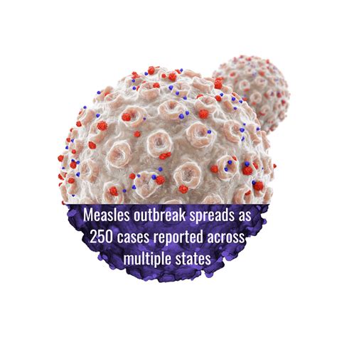 Measles Outbreak Marks Two Deaths The Hawkeye
