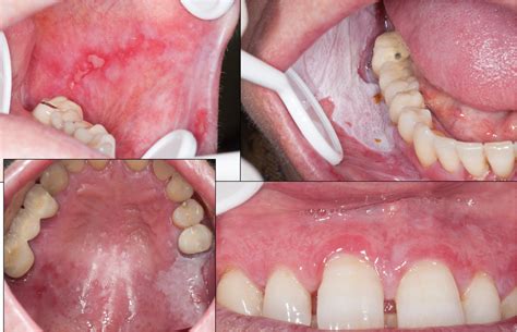 Oral Lichen Planus And Related Lesions What Should We Accept Based On