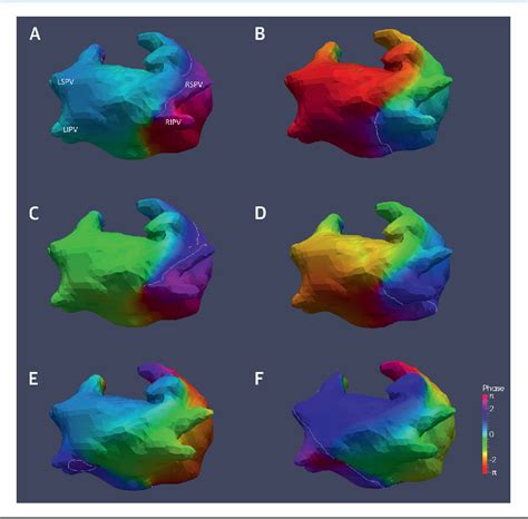 Persistent Atrial Fibrillation Semantic Scholar