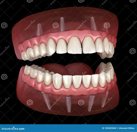 Maxillary And Mandibular Prosthesis With Gum All On 4 System Supported By Implants Medically
