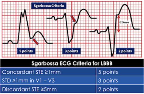 STEMI And STEMI Equivalents I E Who Needs The Cath Lab Now Taming The SRU