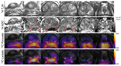 Translation Of Carbon 13 Epi For Hyperpolarized Mr Molecular Imaging Of Prostate And Brain