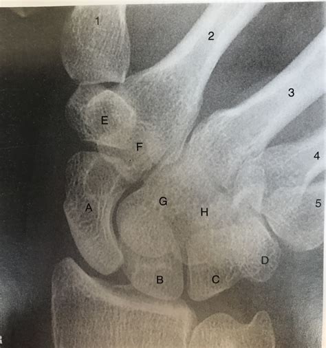 Axial Scaphoid Stetcher Method Diagram Quizlet