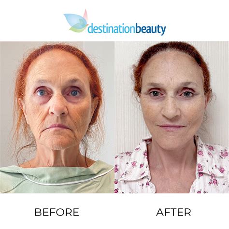 Lorae Is Now Looking 15 Years Younger After Facelift Surgery In Thailand Destination Beauty