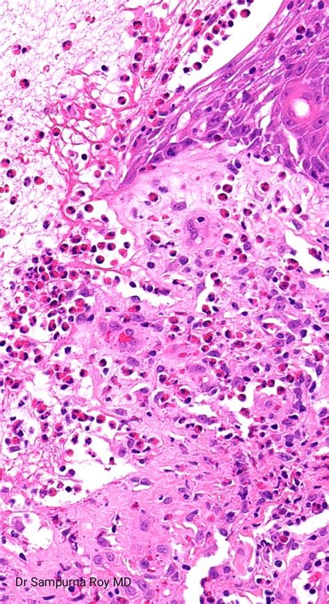 Pathology Of Chondroid Syringoma Artofit
