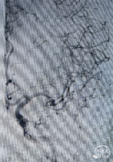 中枢介入第363期：大脑中动脉三叉口狭窄微导丝保护扩张支架置入 脑医汇