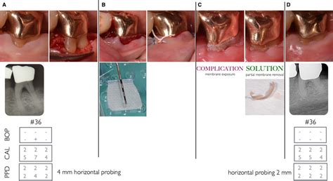 Healing Complication Membrane Exposure Tooth 36 With A Buccal Class