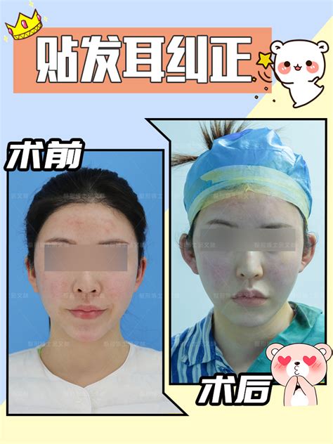 再造耳朵图片耳朵整形危险吗 哔哩哔哩