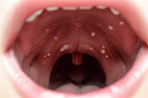 🔍 What Causes White Spots On Tonsils Expert Guide 2025 Myentcare