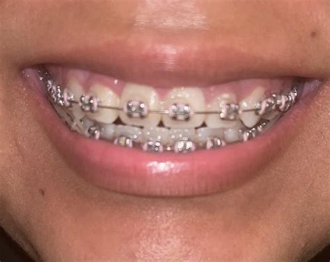 Bite Adjustment After Elastics Rbraces