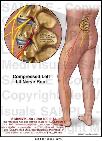 Compressed Left L Nerve Root Medical Illustration Medivisuals