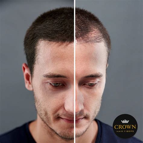 Hairstyles For Crown Balding Men