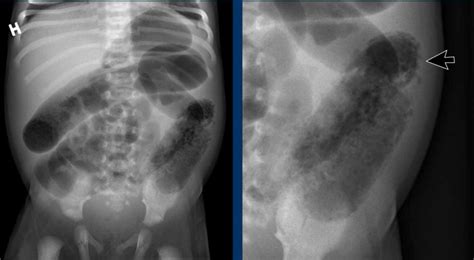 The Radiology Assistant Necrotizing Enterocolitis