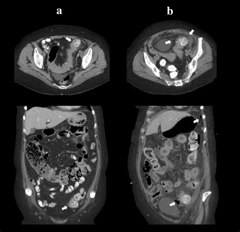 Progression Of Stercoral Colitis Over Time In 48 Year Old Female A Download Scientific Diagram