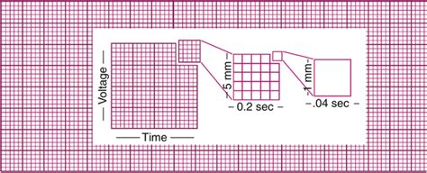 The Electrocardiogram And Cardiac Arrhythmias In Adults Clinical