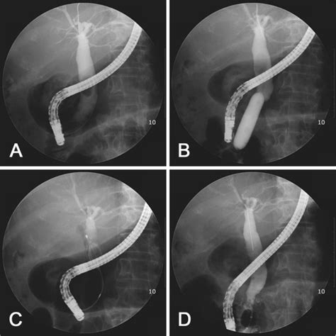 Fluoroscopic View Of Large Balloon Dilatation Without Biliary