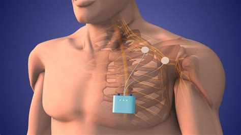 Peripheral Nerve Stimulation What To Expect During And After Your
