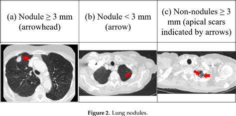 figure 1 from lung nodule classification using taguchi based convolutional neural networks for