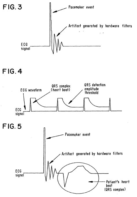 brevet ep1435217a2 pacemaker pulse detection and artifact rejection