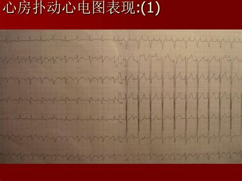 心房扑动的心电图 word文档在线阅读与下载 无忧文档