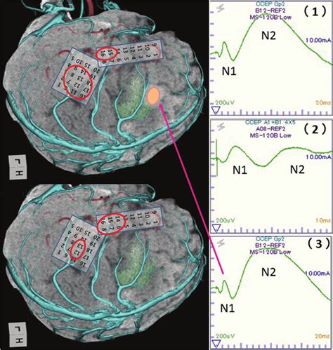 Intraoperative Evaluation Of Language Function By Electrical