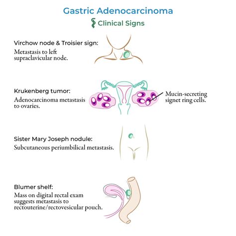 Clinical Pathology Glossary Gastric Cancer Ditki Medical