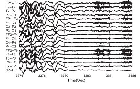 Figure 3 From A Machine Learning Algorithm For Detecting Seizure Termination In Scalp Eeg