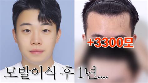 20대 남자 모발이식 1년 차 탈모는 일찍 잡으세요 저처럼 고생하지 마시고 [쀼] Youtube