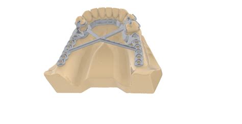 Stl File Rpd Framework For Slm Cnc And 3d Printing 🦷 Obj And 3mf ・3d