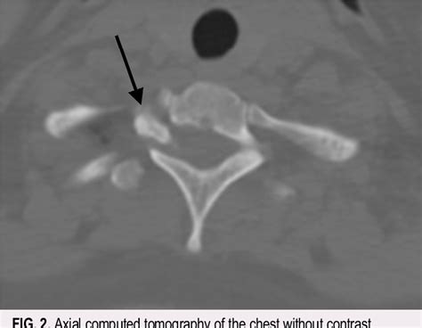 Figure 1 From Intraspinal Cervicothoracic Junction Chondrosarcoma