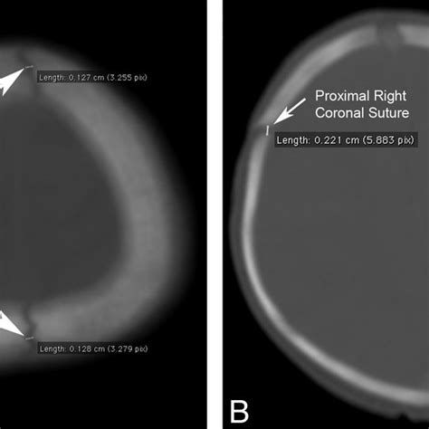 Pdf Normal Sagittal And Coronal Suture Widths By Using Ct Imaging
