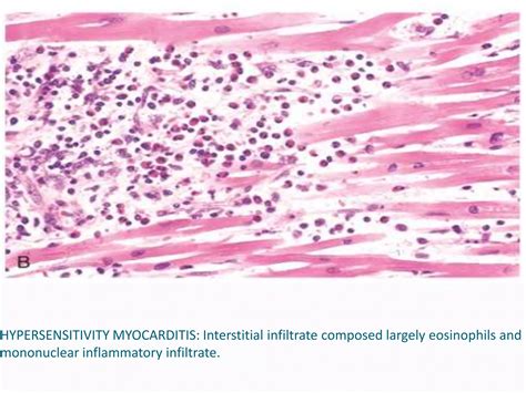 An Approach To Myocardial Biopsy Interpretation Ppt