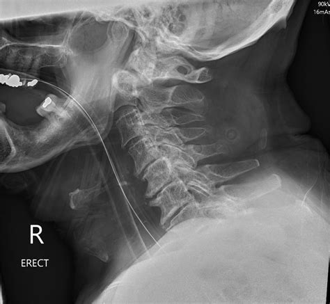 Dens Odontoid Fracture The Bone School