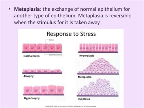 Metaplasia And Dysplasia