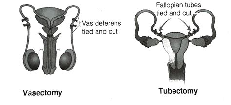 The Correct Surgical Procedure As A Contraceptive Method Is