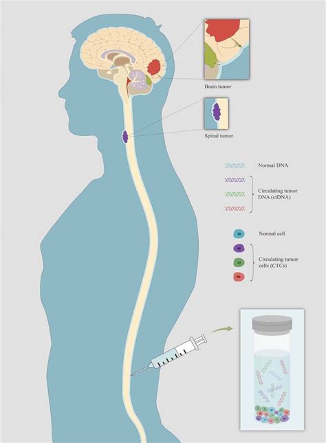 Clinical Applications Of Cerebrospinal Fluid Circulating Tumor Dna As A Liquid Biopsy For