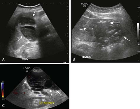 Abdominal Abscess Radiology Key