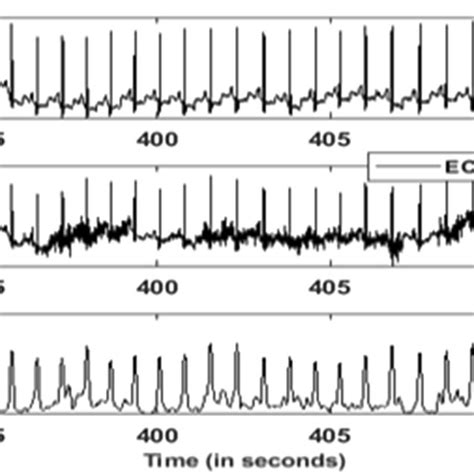 A Ecg Record Number 100 From Mit Bih Arrhythmia Database B Ecg Record