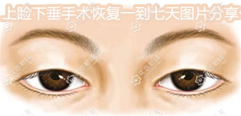 上睑下垂 上睑下垂手术费用多少 上睑下垂手术可以维持多久 上睑下垂怎么治疗 花容眼睛