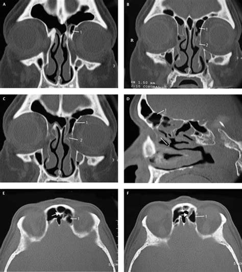 Surgical Approach To The Frontal Sinus And Frontal Recess Ento Key
