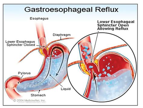 A Refluxról Kicsit Más Szemmel Is Dr Wallinger Zita Testi Lelki Egészség Blog Dr