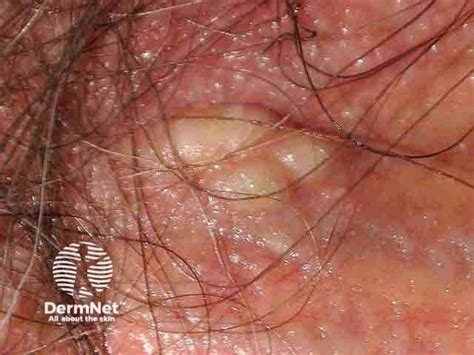 Vulval Cyst Images