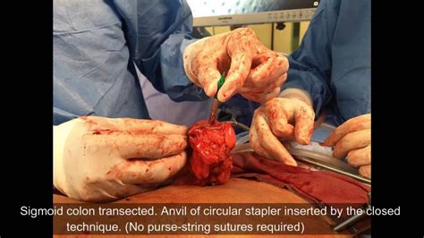 Laparoscopic Sigmoid Colectomy For Sigmoid Colon Cancer Drjka