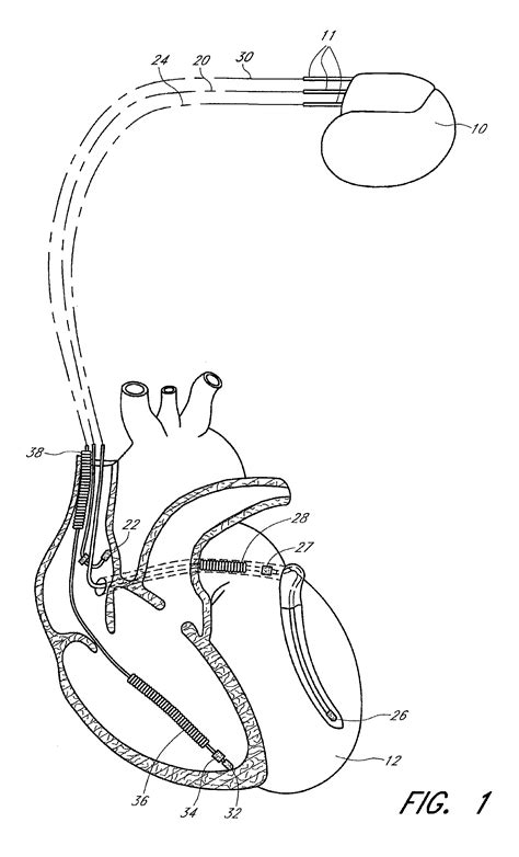 Feed Through Capacitors Patented Technology Retrieval Search Results Eureka Patsnap Develop