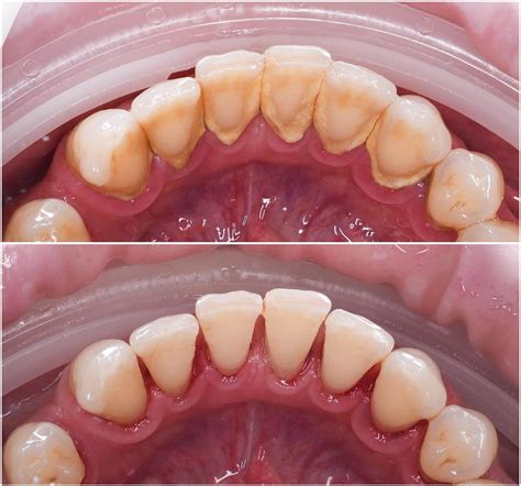 Claves Para Una Limpieza Dental Efectiva Y Saludable En Sevilla