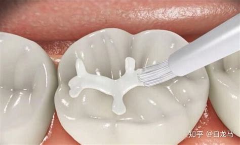 成人牙齿需要每年涂氟吗 知乎