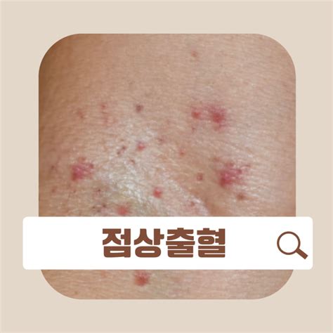 점상출혈 원인 혈소판 감소증 치료 진단법 네이버 블로그