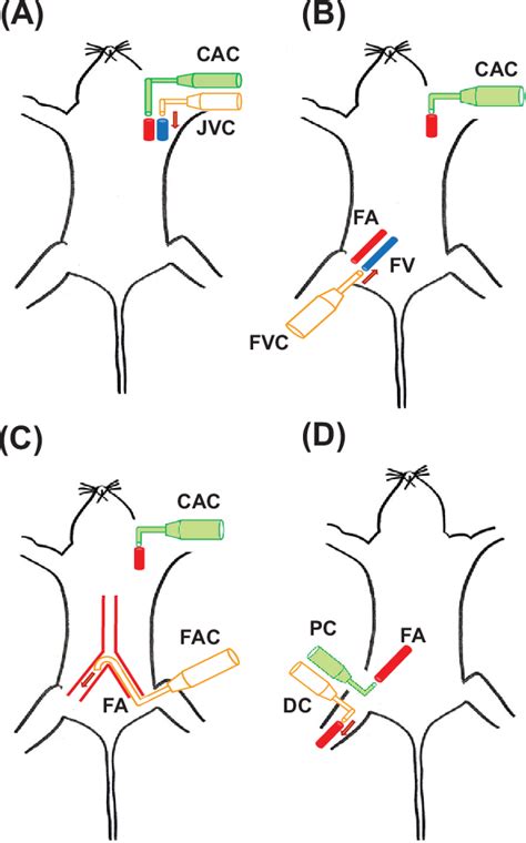 Figure 1 From Retrograde Cannulation Of Femoral Artery A Novel