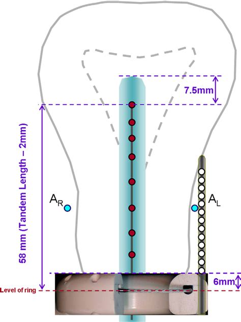 figure 1 from recommendations from gynaecological gyn gec estro